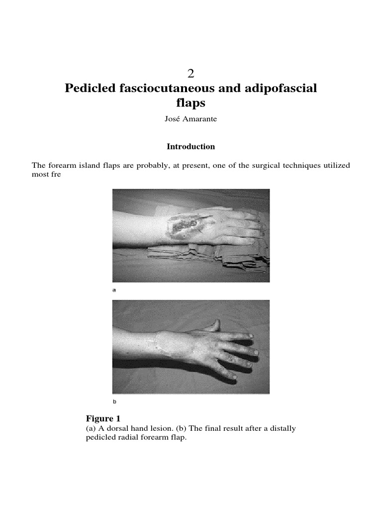 Pedicled Fasciocutaneous and Adipofascial Flaps | Human Anatomy | Limbs ...