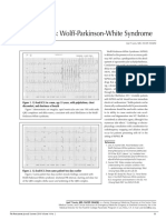 Delta Wave in ECG: WPW Insights | PDF | Cardiac Electrophysiology ...