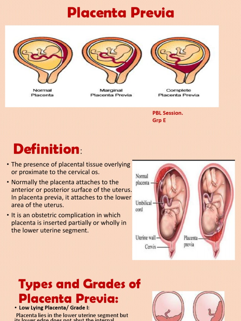 Placenta Previa Types