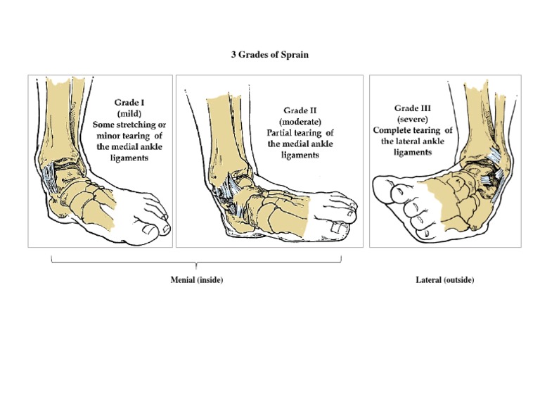 3 Grades of Sprain: Menial (Inside) Lateral (Outside) | PDF