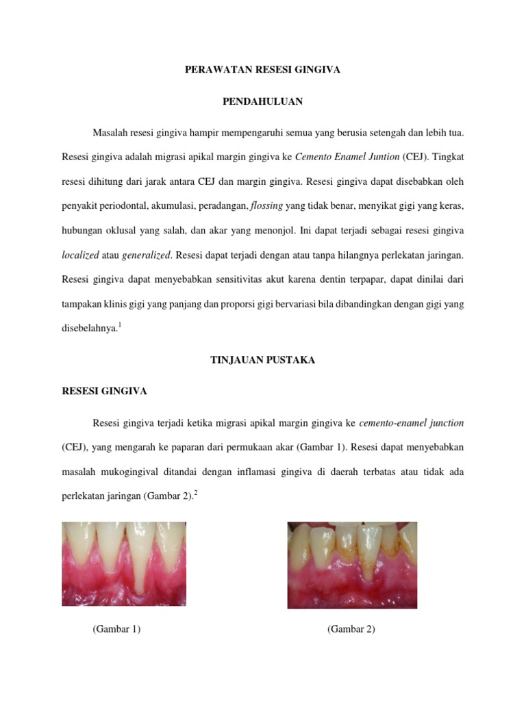 Perawatan Resesi Gingiva | PDF