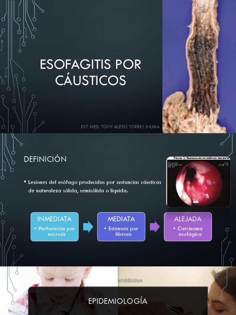 ESOFAGITIS POR CAUSTICOS Tony | PDF | Vómitos | Dolor