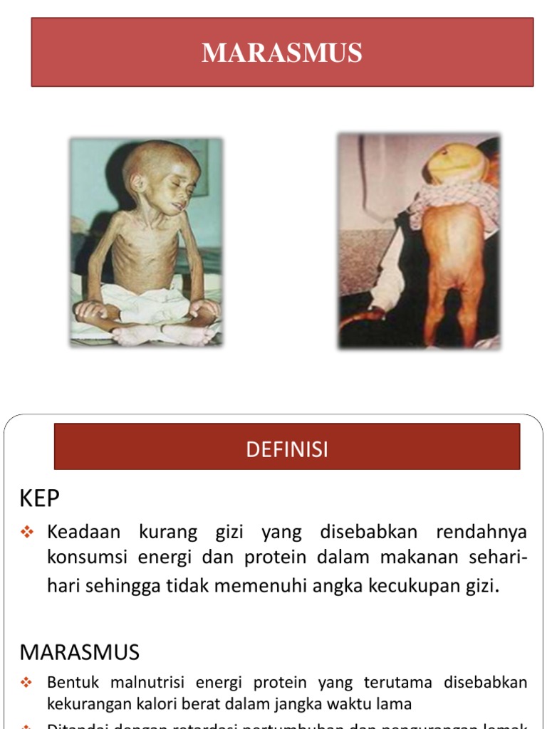 Klasifikasi dan Gejala Marasmus | PDF