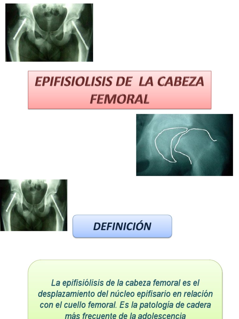 EPIFISIOLISIS | PDF | Sistema esquelético | Sistema musculoesquelético
