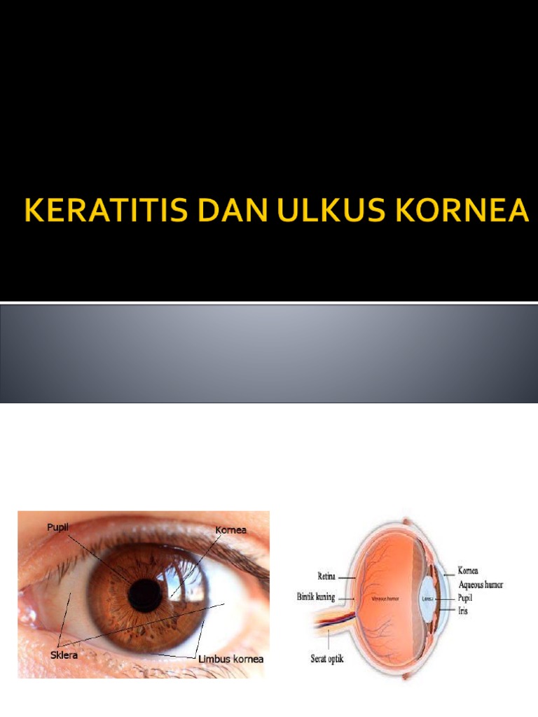 Keratitis - Ulkus Kornea | PDF