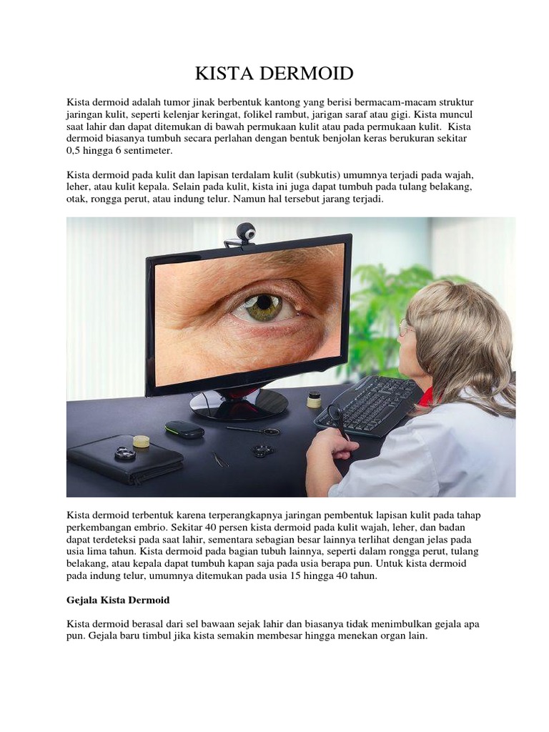 Kista Dermoid | PDF