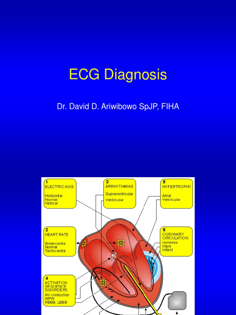 Ecg Diagnosis: Dr. David D. Ariwibowo SPJP, Fiha | PDF | Cardiology ...