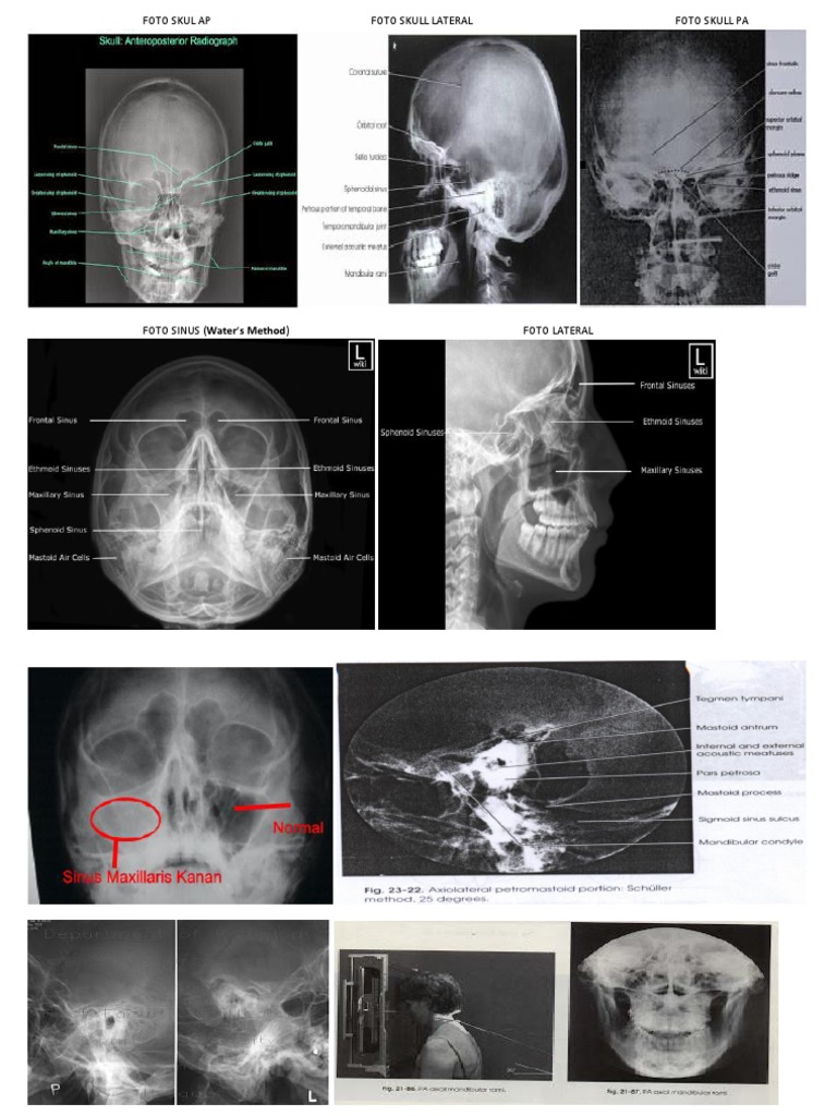 Gambaran Rontgen Skull | PDF