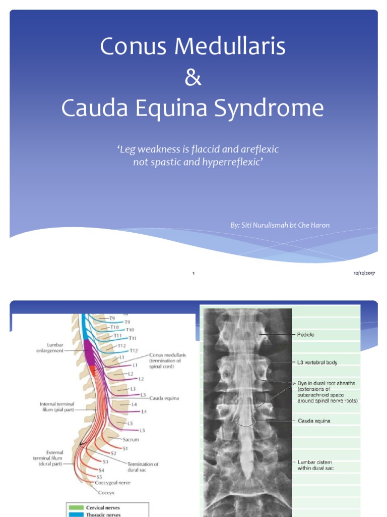 Cauda Equina Syndrome Vs Conus Medullaris