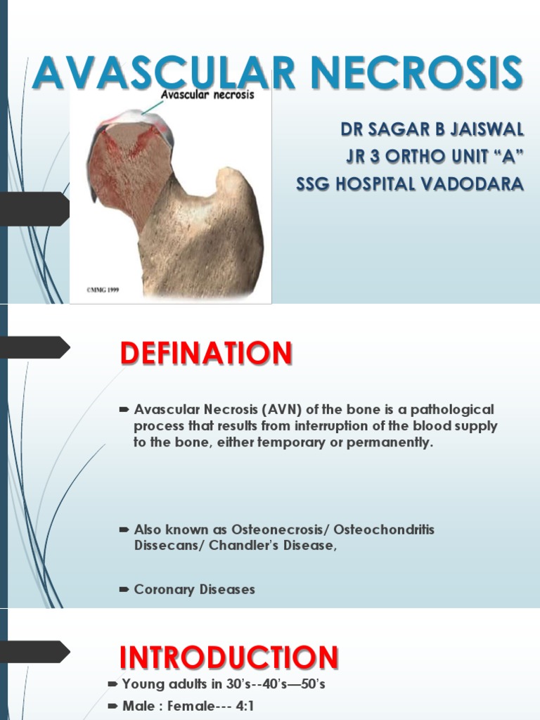 Avascular Necrosis Overview and Insights | PDF | Bone | Hip