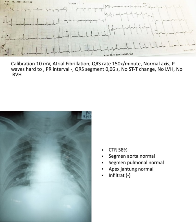 Calibration 10 MV, Atrial Fibrillation, QRS Rate 150x/minute, Normal ...