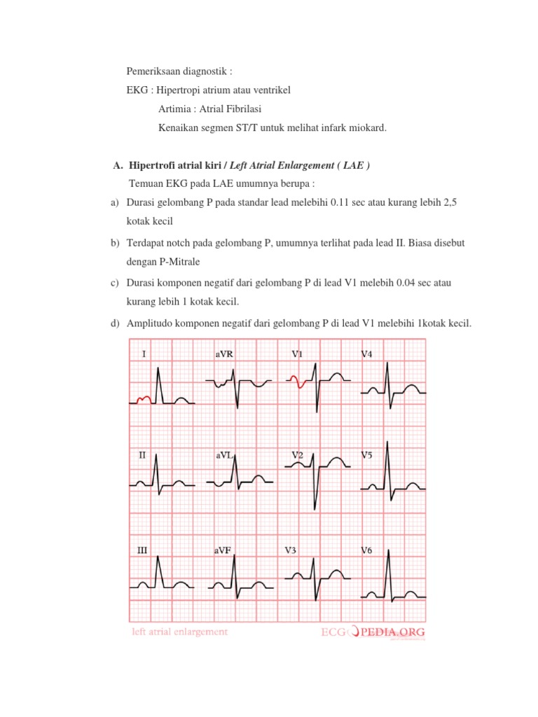 Analisis EKG untuk Hipertrofi Jantung, Arritmia dan Infark Miokard | PDF