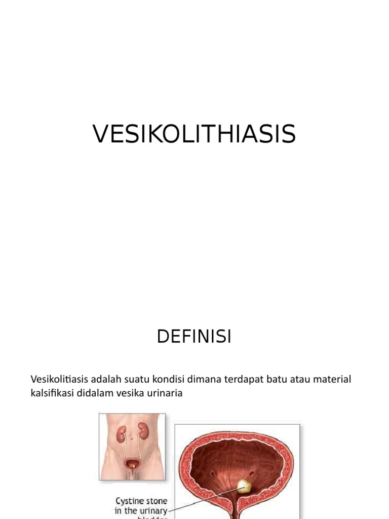 DD Vesikolithiasis | PDF