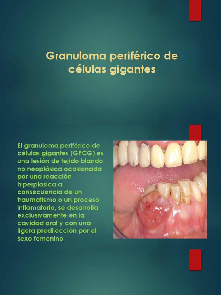 Granuloma Periférico de Células Gigantes | PDF