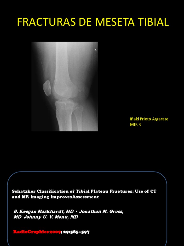 Fracturas de meseta tibial.pdf | Rodilla | Sistema esquelético