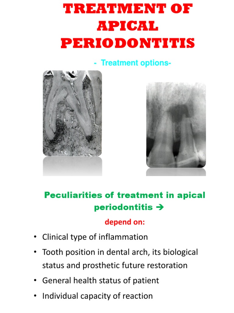 Apical Periodontitis Treatment Guide | PDF | Health Care | Diseases And ...