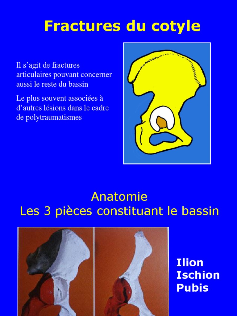 04- Fractures Du Cotyle | Système squelettique | Appareil locomoteur