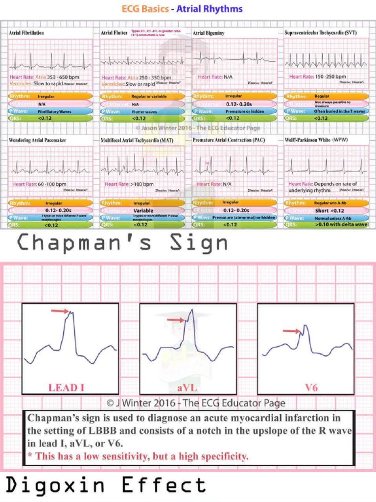 ECG Flashcards | PDF