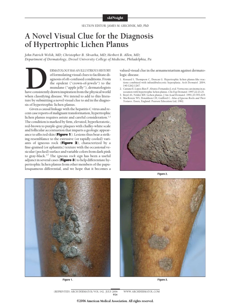 A Novel Visual Clue for the Diagnosis of Hypertrophic Lichen Planus ...