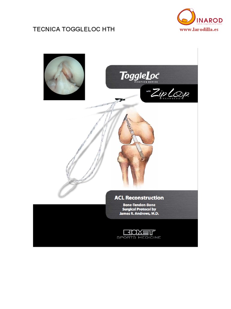 Técnica Toggleloc para Plastia HTH | PDF | Extremidades (anatomía ...