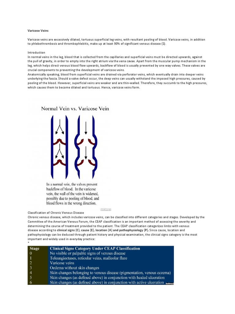 Varicose Veins | PDF | Varicose Veins | Vein