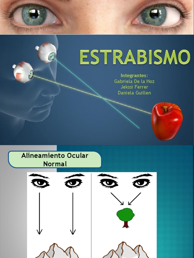 Estrabismo | PDF | Percepción visual | Ojo