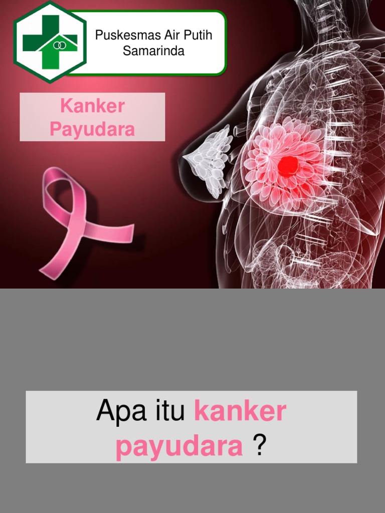 Presentasi Kanker Payudara | PDF