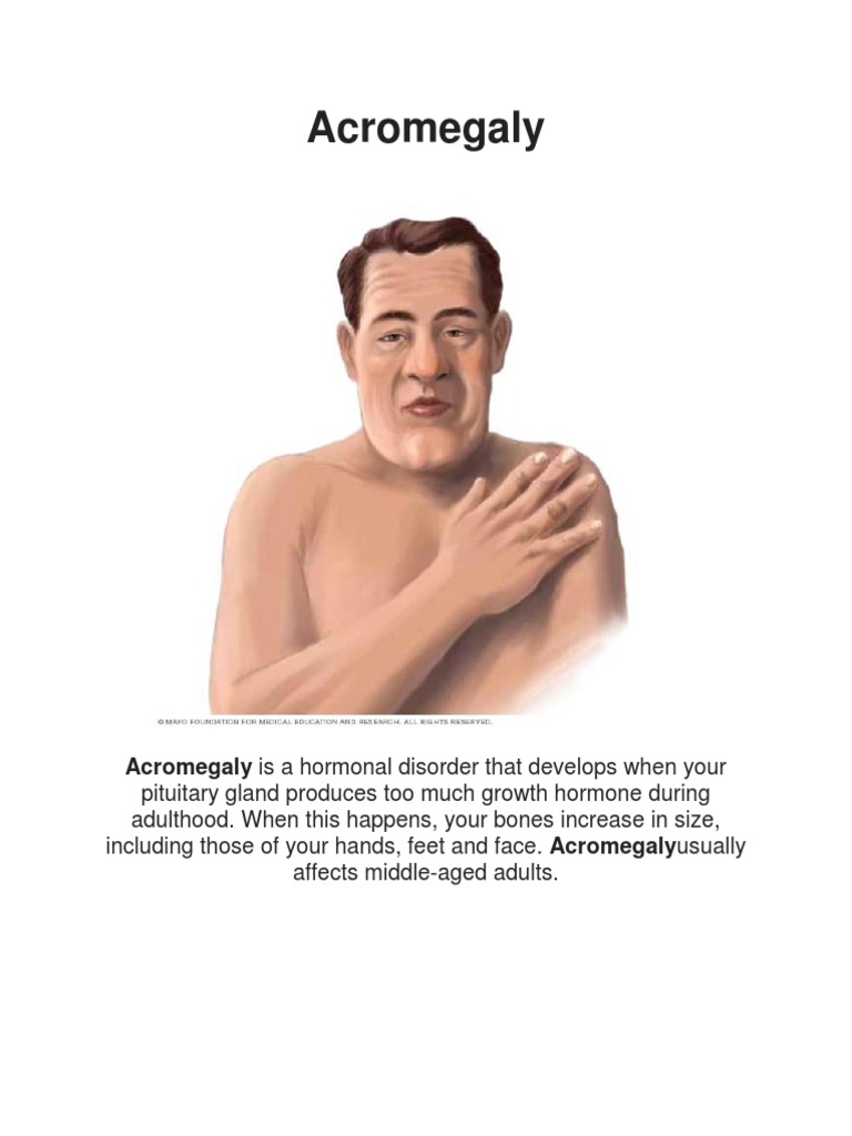 Acromegaly: Acromegaly Is A Hormonal Disorder That Develops When Your | PDF