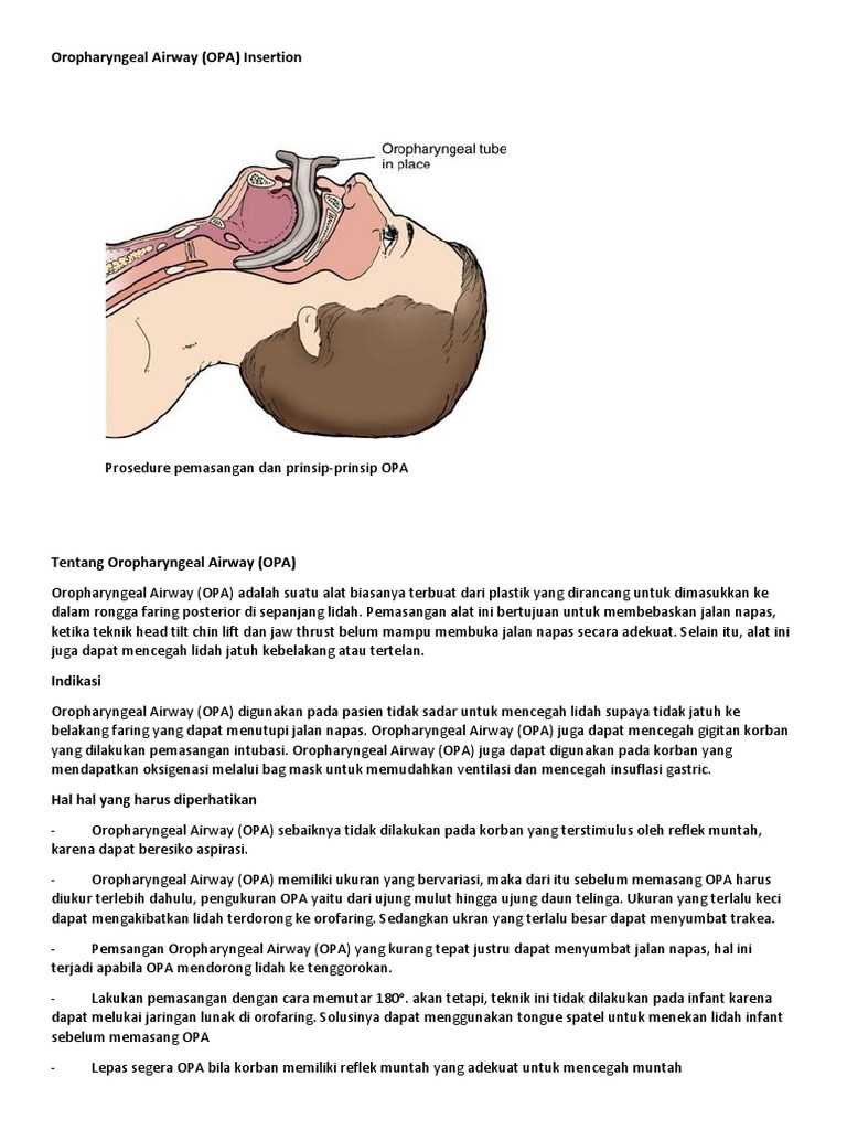 Panduan Pemasangan Oropharyngeal Airway | PDF | Kesehatan Holistik ...