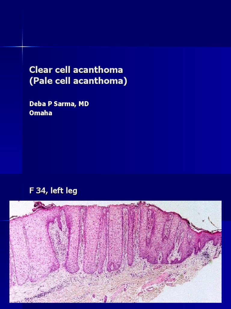Clear Cell Acanthoma., F 34, Left Leg | PDF