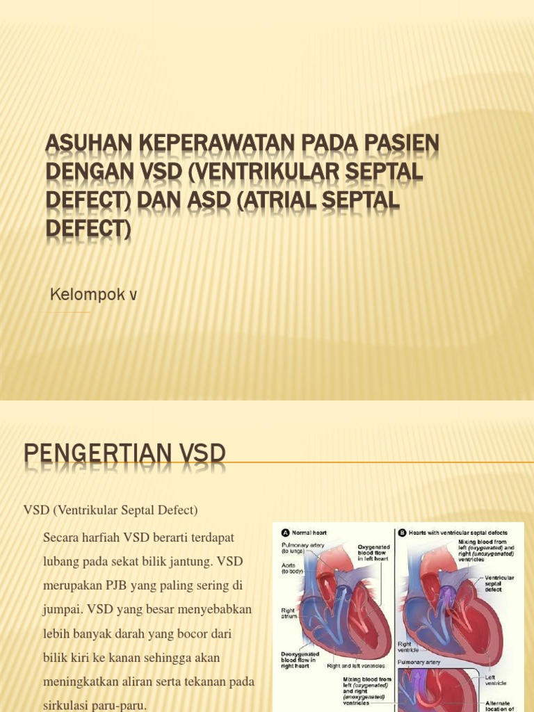 Asd VSD | PDF