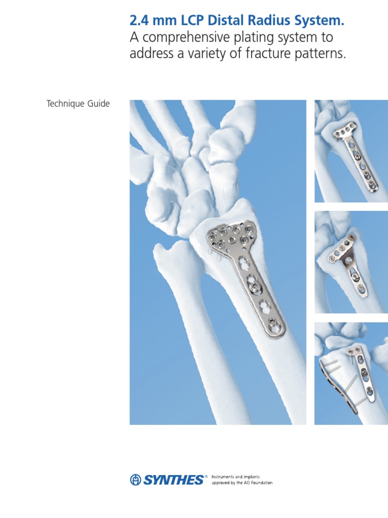 Radius Distal | Screw | Hand