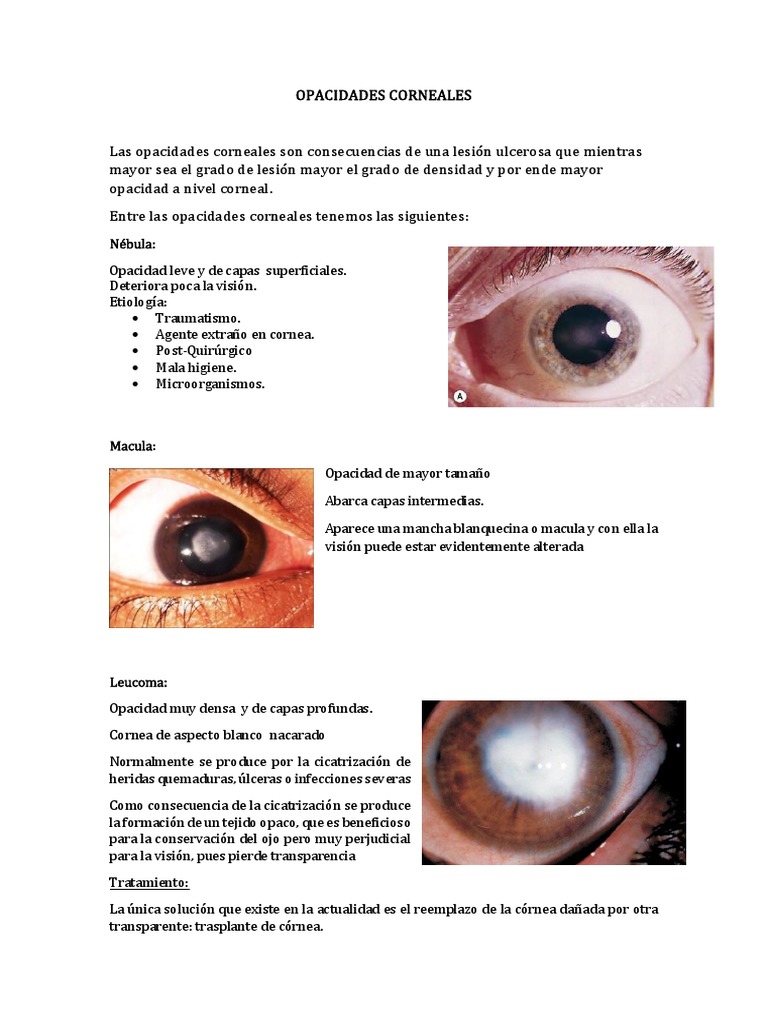 Opacidad corneal & Trastornos degenerativos corneales | Ojo humano | Córnea