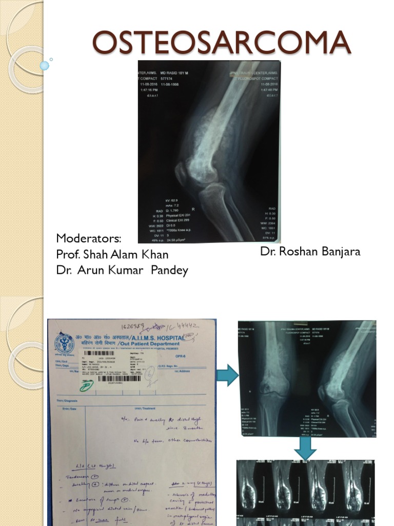 OSTEOSARCOMA | PDF | Neoplasms | Medical Specialties