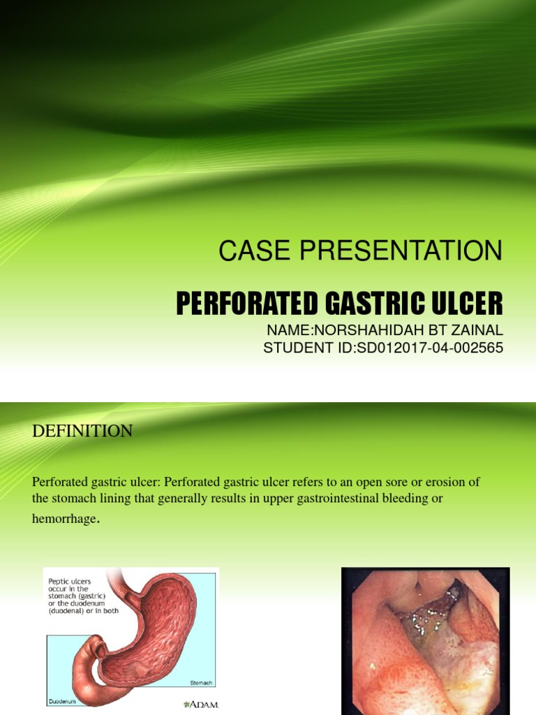 Perforated Gastric Ulcer | PDF | Clinical Medicine | Medical Specialties