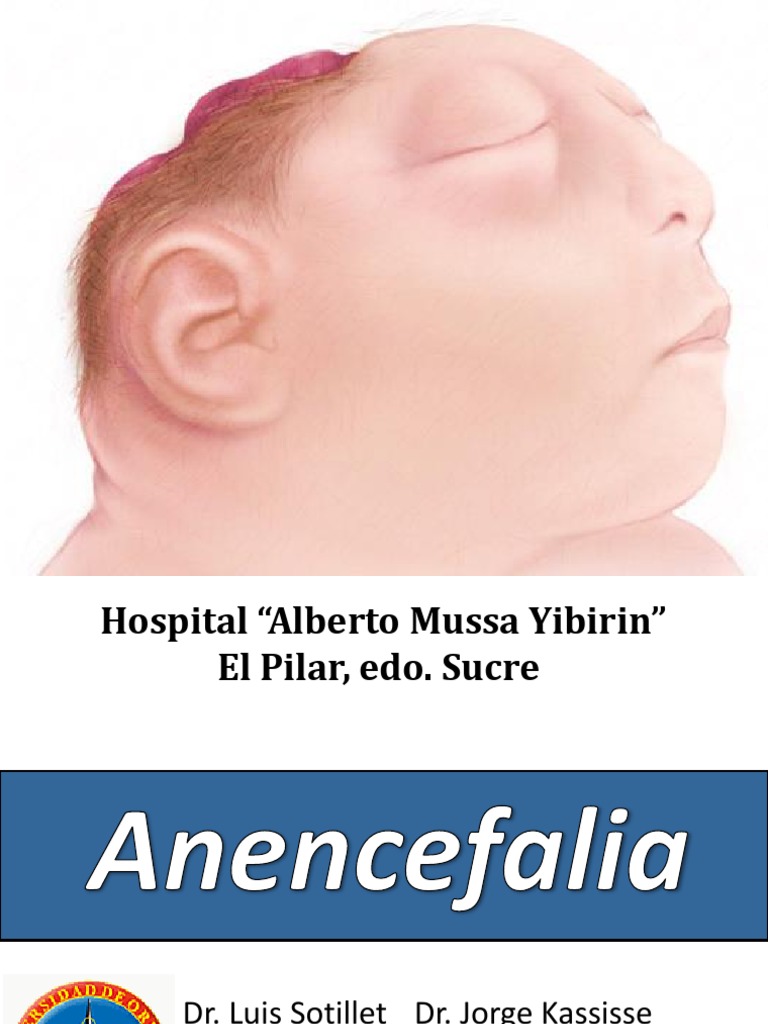 Anencefalia: Causas, Diagnóstico y Prevención | PDF | Enfermedades y ...