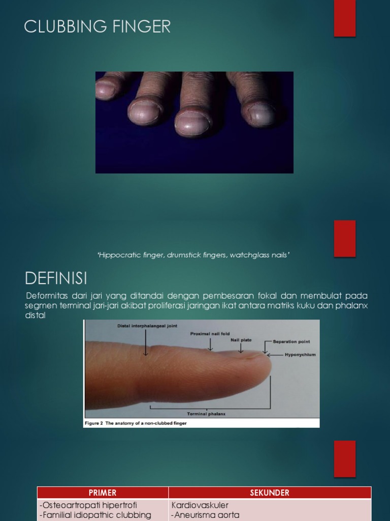 Clubbing Finger | PDF