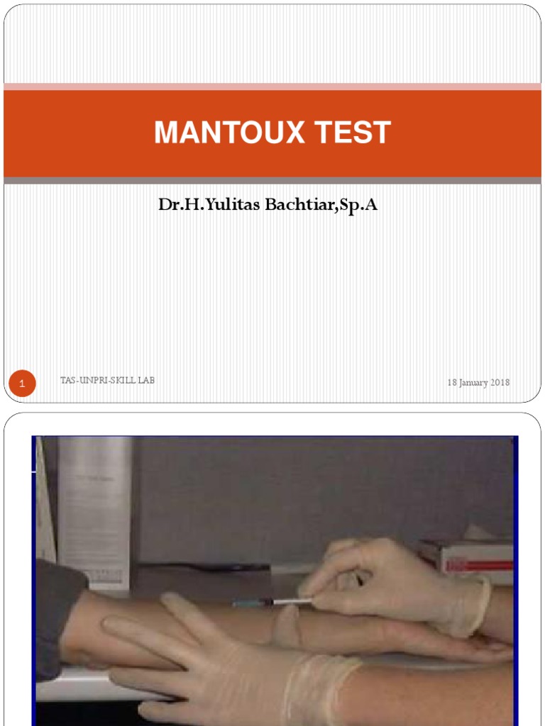 Mantoux Test | PDF
