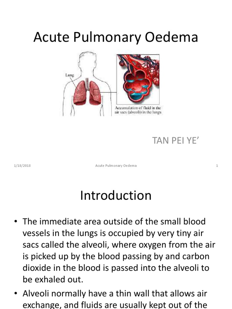 Acute Pulmonary Oedema | PDF | Edema | Lung