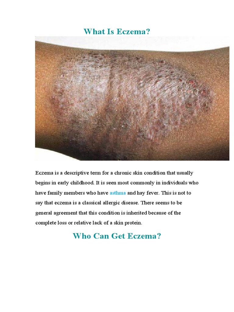 What Is Eczema | Download Free PDF | Dermatitis | Topical Medication
