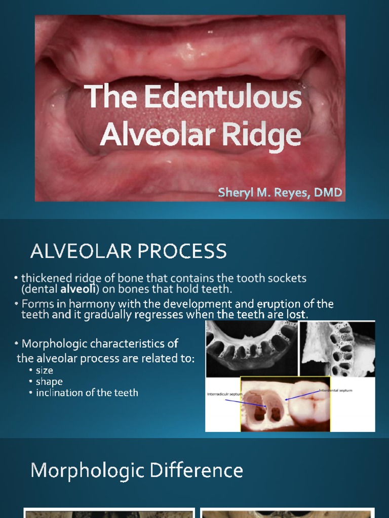 Edentulous Alveolar Ridge | PDF