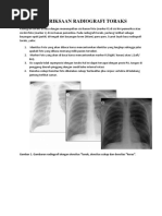 PDF Anatomi Thorax Normal Gambaran Radiologi Compress | PDF