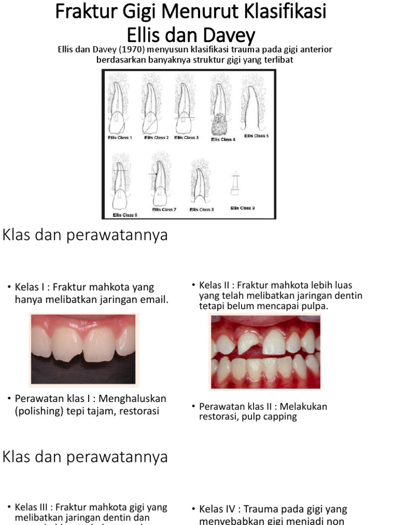 Fraktur Gigi Menurut Klasifikasi Ellis Dan Davey | PDF