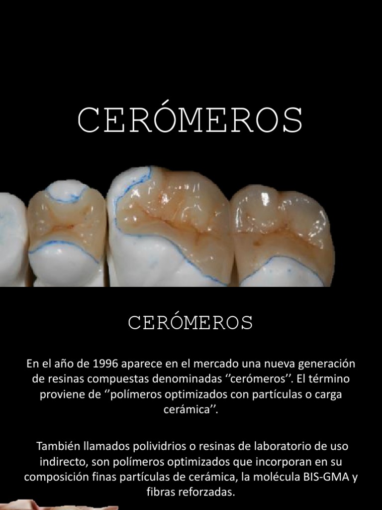 Cerómeros en Odontología: Ventajas y Usos | PDF | Lentes | Aluminio