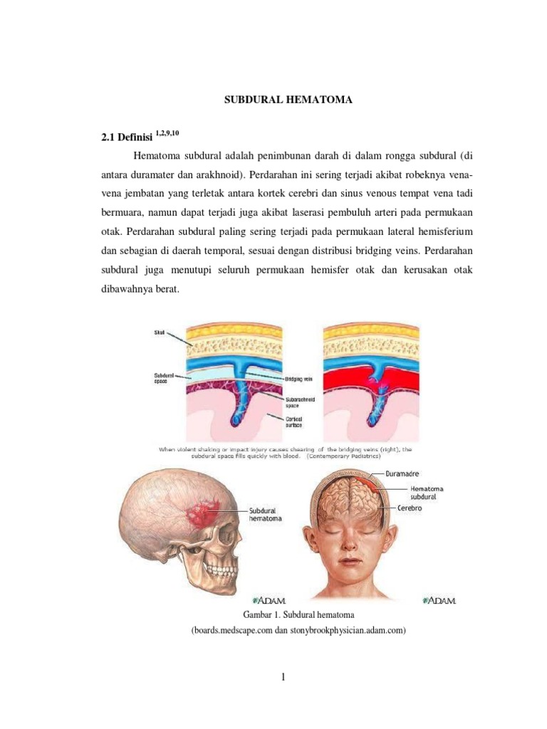 Subdural Hematom | PDF