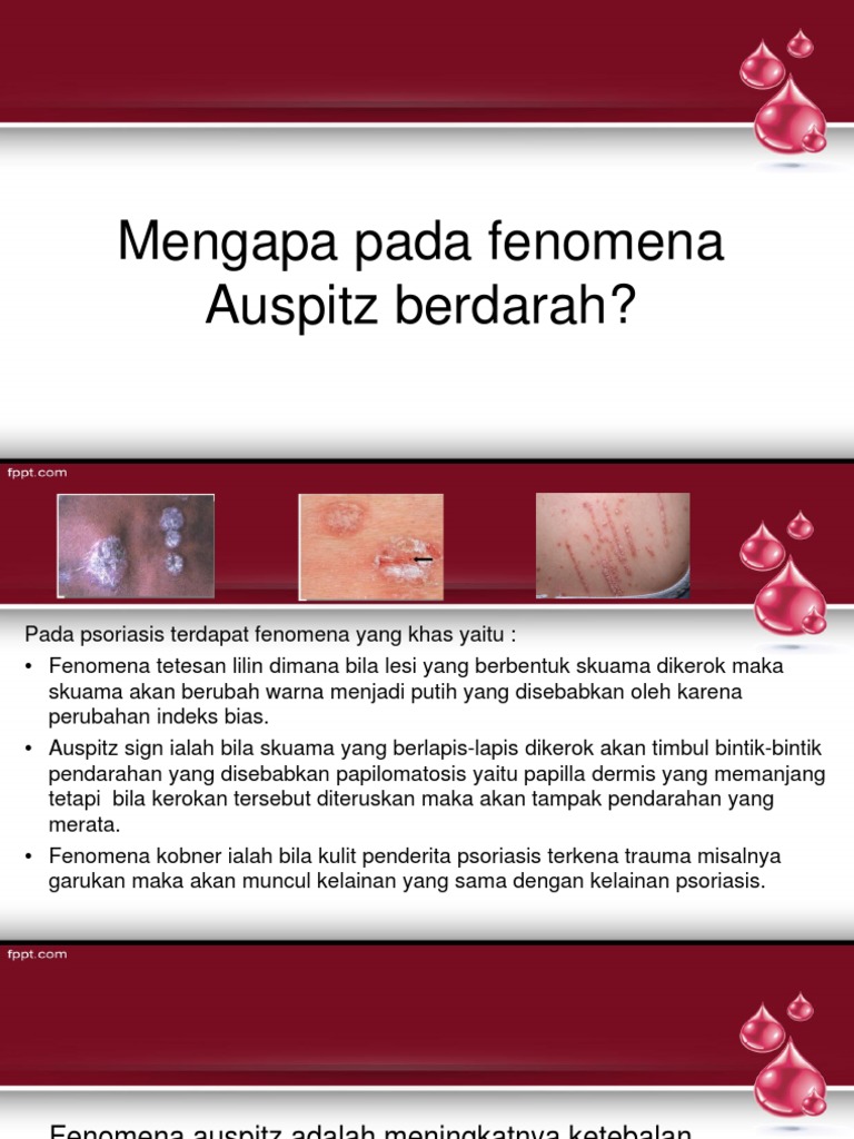 Fenomena Auspitz dalam Psoriasis | PDF