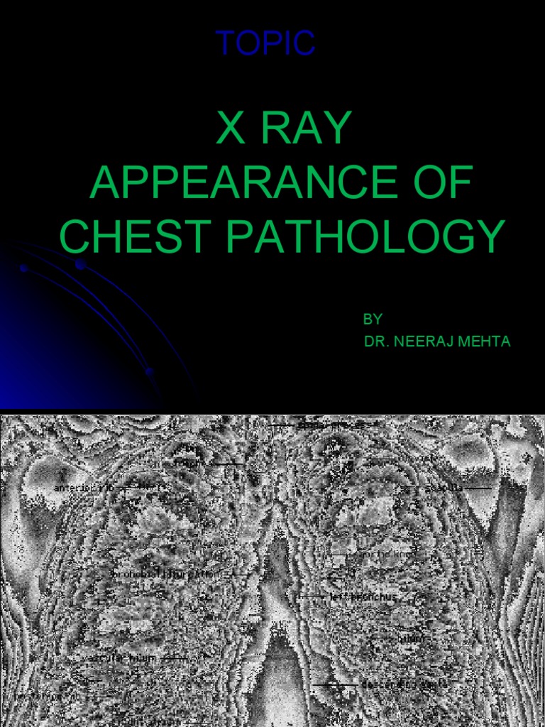 X Ray Appearance of Chest Pathology | PDF | Aorta | Lung