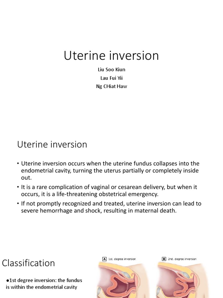 Uterine Inversion: Liu Soo Kiun Lau Fui Yii NG Chiat Haw | PDF | Uterus ...