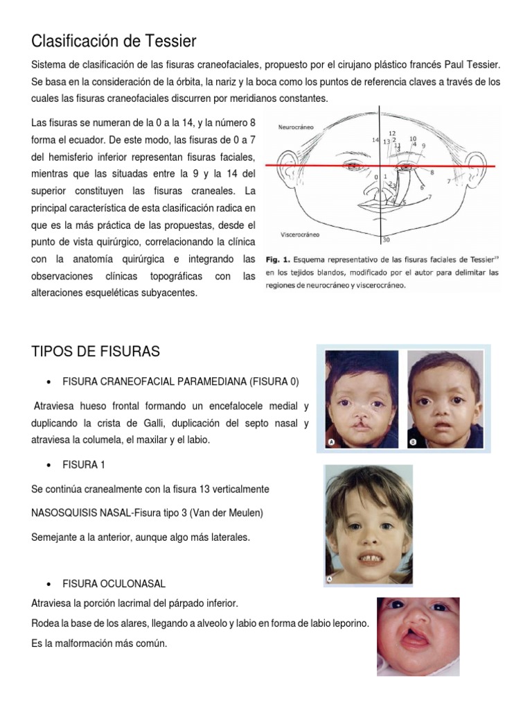 Clasificación de Fisuras de Tessier | PDF | Cara | Sistema ...