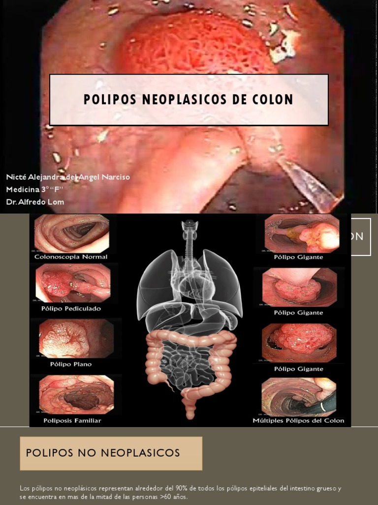 Pólipos Neoplásicos de Colon: Tipos y Riesgos | PDF | Cáncer ...